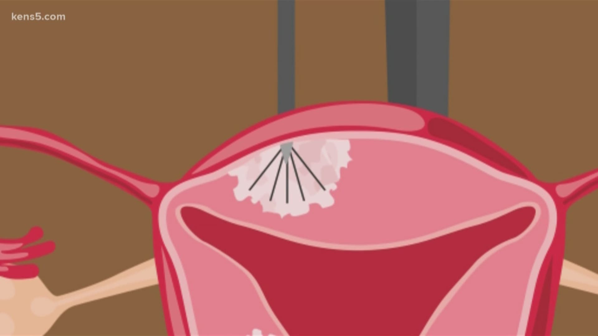 Acessa procedure helps women avoid hysterectomies | kens5.com