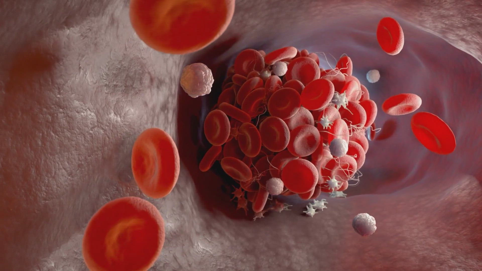 Deep vein thrombosis: Explaining the injury that ended Wemby's season ...