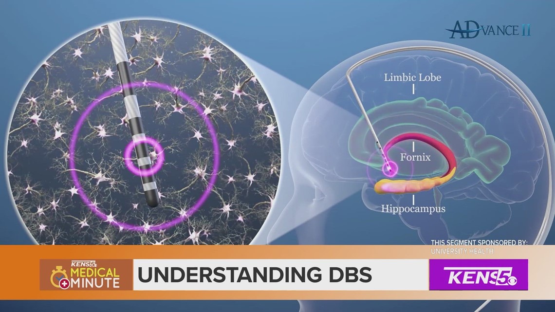 Benefits of Deep Brain Stimulation | Great Day SA | kens5.com