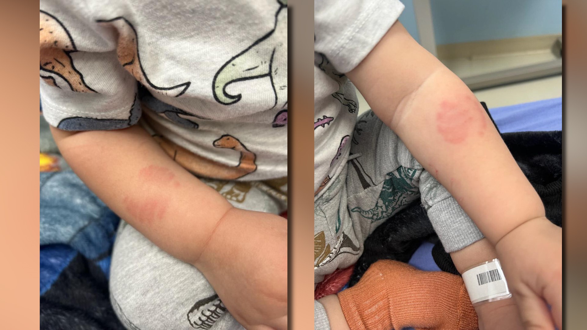 'How can you not notice eight bites?' Family alleges toddler's injuries ...