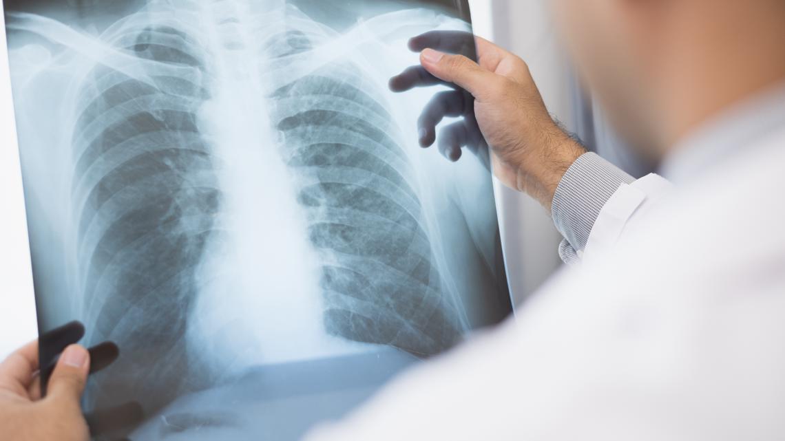 At-home screening aims to reduce wait times for cancer results | kens5.com