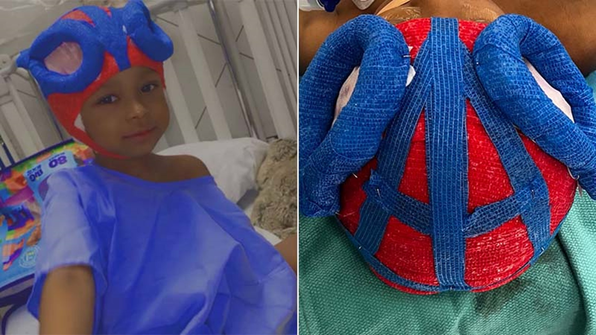 See how kids with skull and facial trauma turn into superheroes | kens5.com