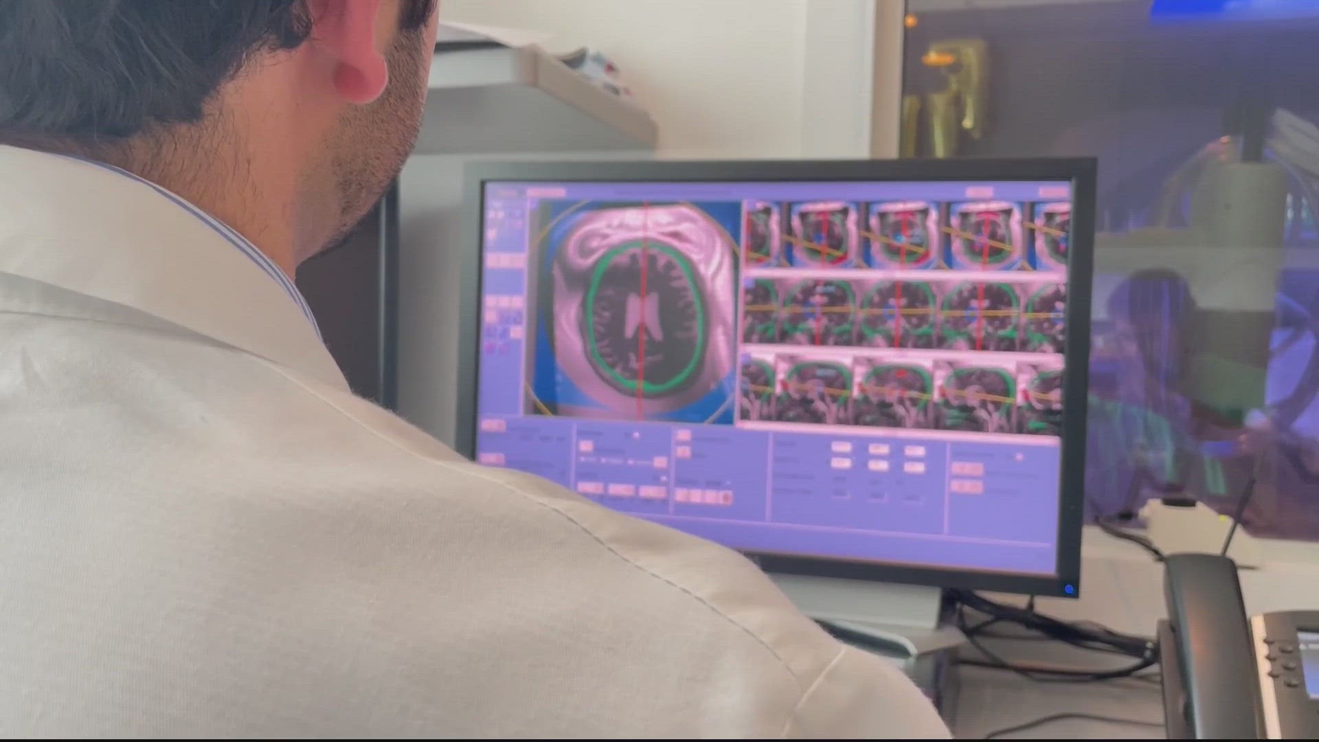 UVAHealth does brain surgery without scalpels or saws | kens5.com